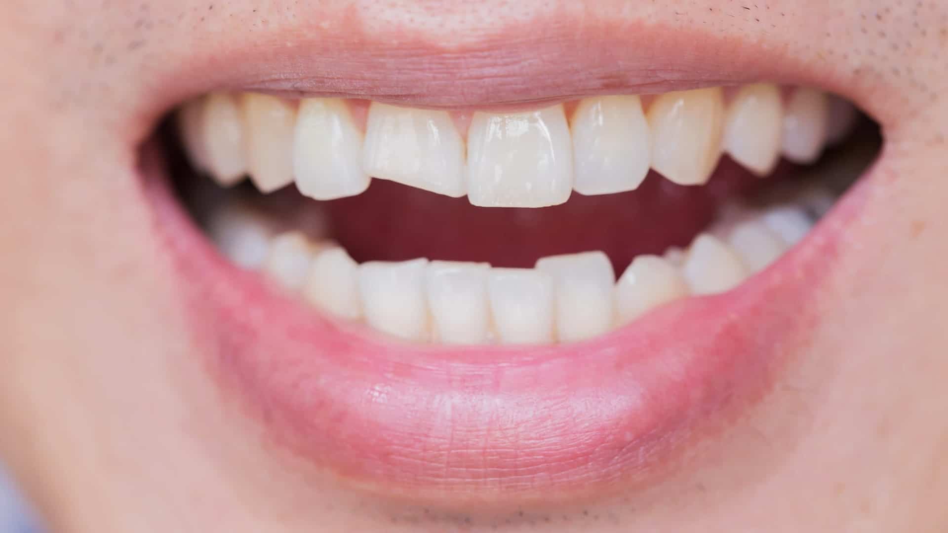 How to Fix Chipped Teeth | Stanley Dentistry