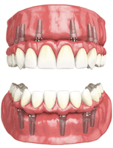 What are the Different Types of Dentures? | Stanley Dentistry