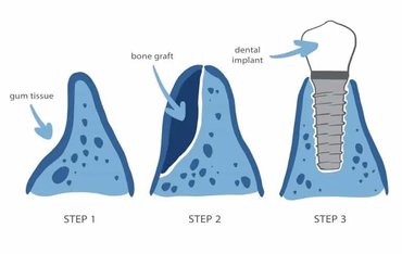Bone Replacement and Grafting in Cary, North Carolina