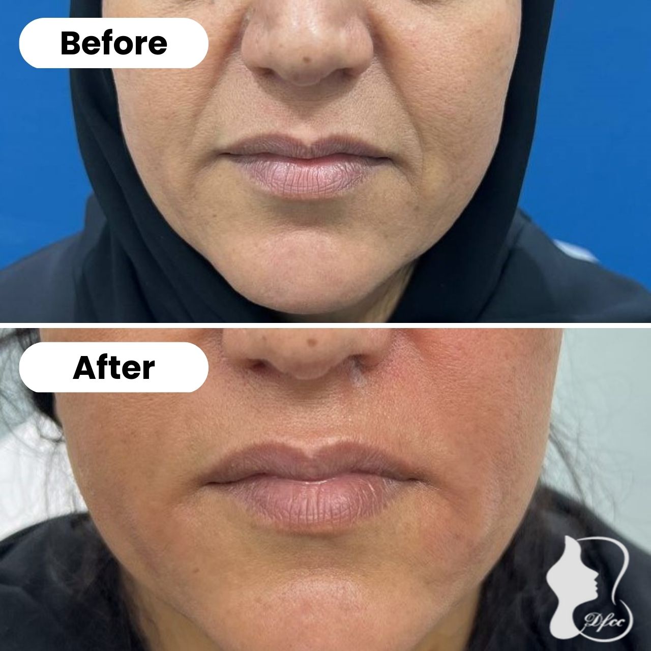 Laugh Lines Treatment