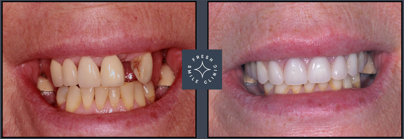 Zygomatic Implants | Fresh Smile Clinic