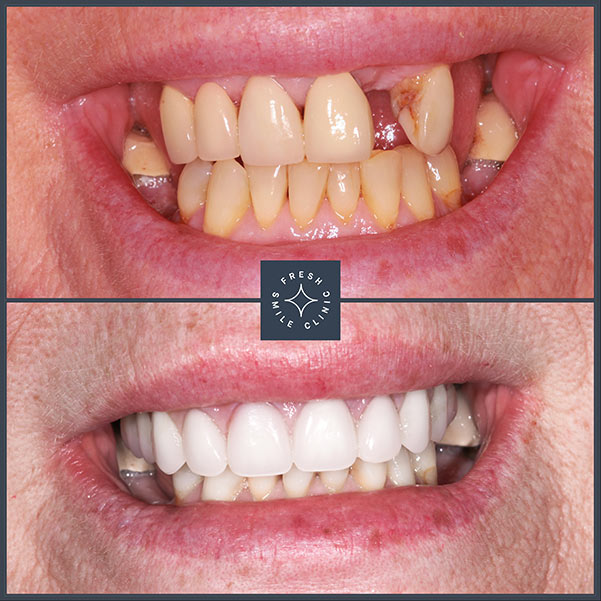 Zygomatic Implants | Fresh Smile Clinic