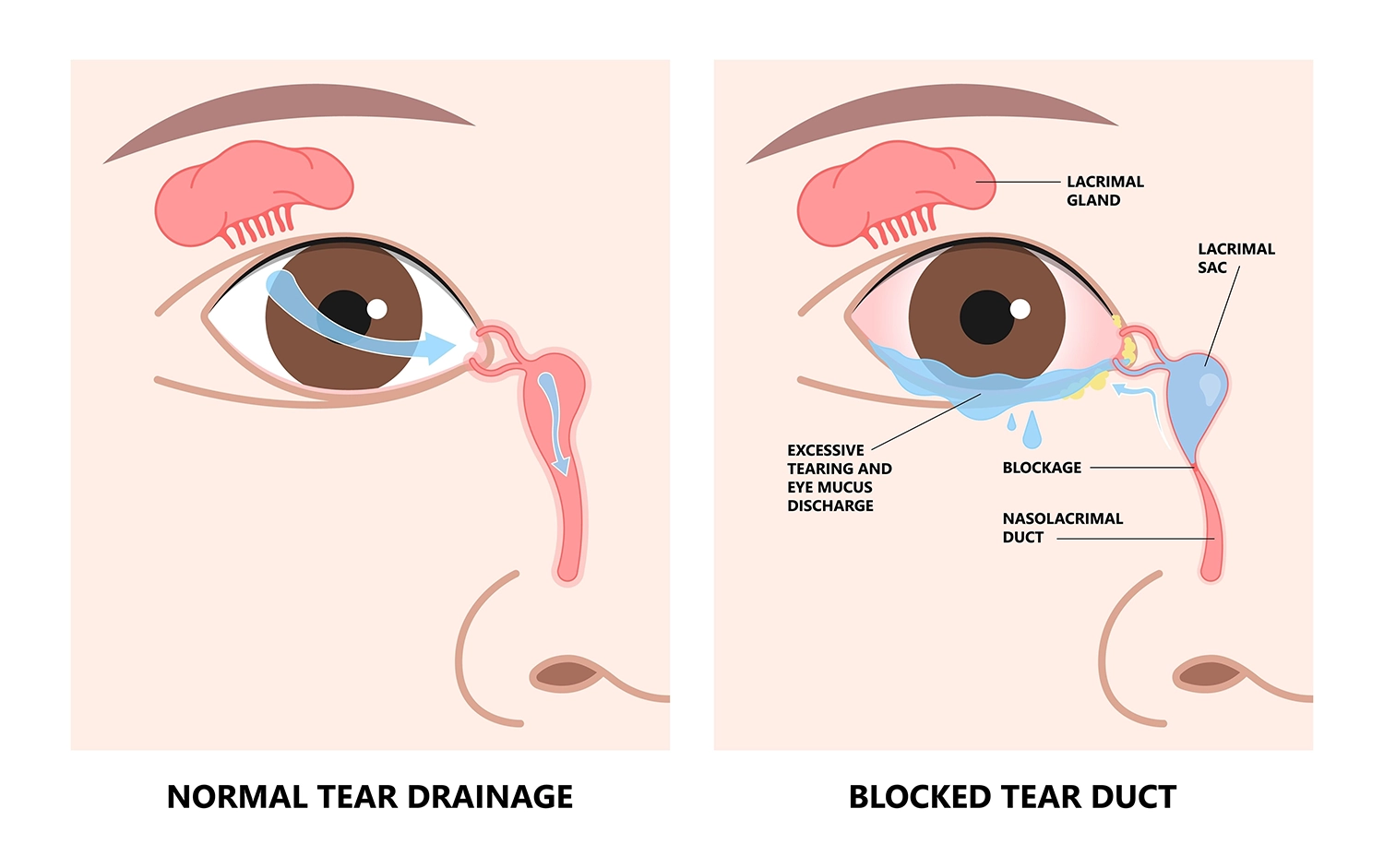 Understanding Blocked Tear Ducts: Causes, Symptoms, Management