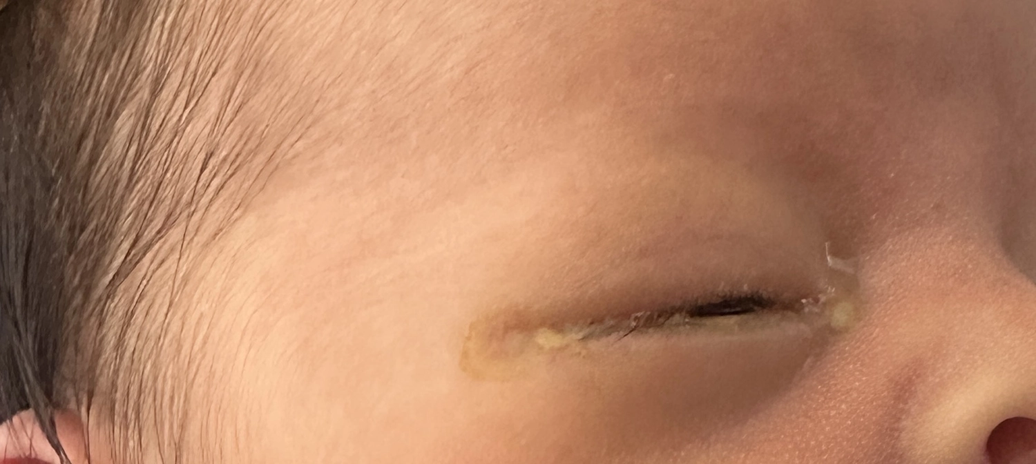 Understanding Blocked Tear Ducts: Causes, Symptoms, Management