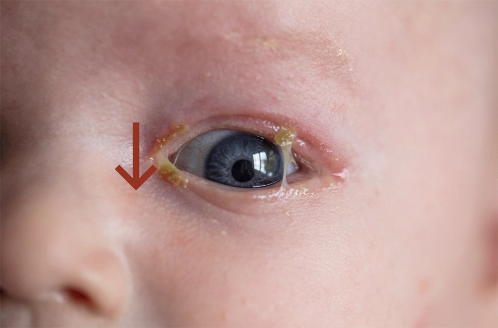 Understanding Blocked Tear Ducts: Causes, Symptoms, Management