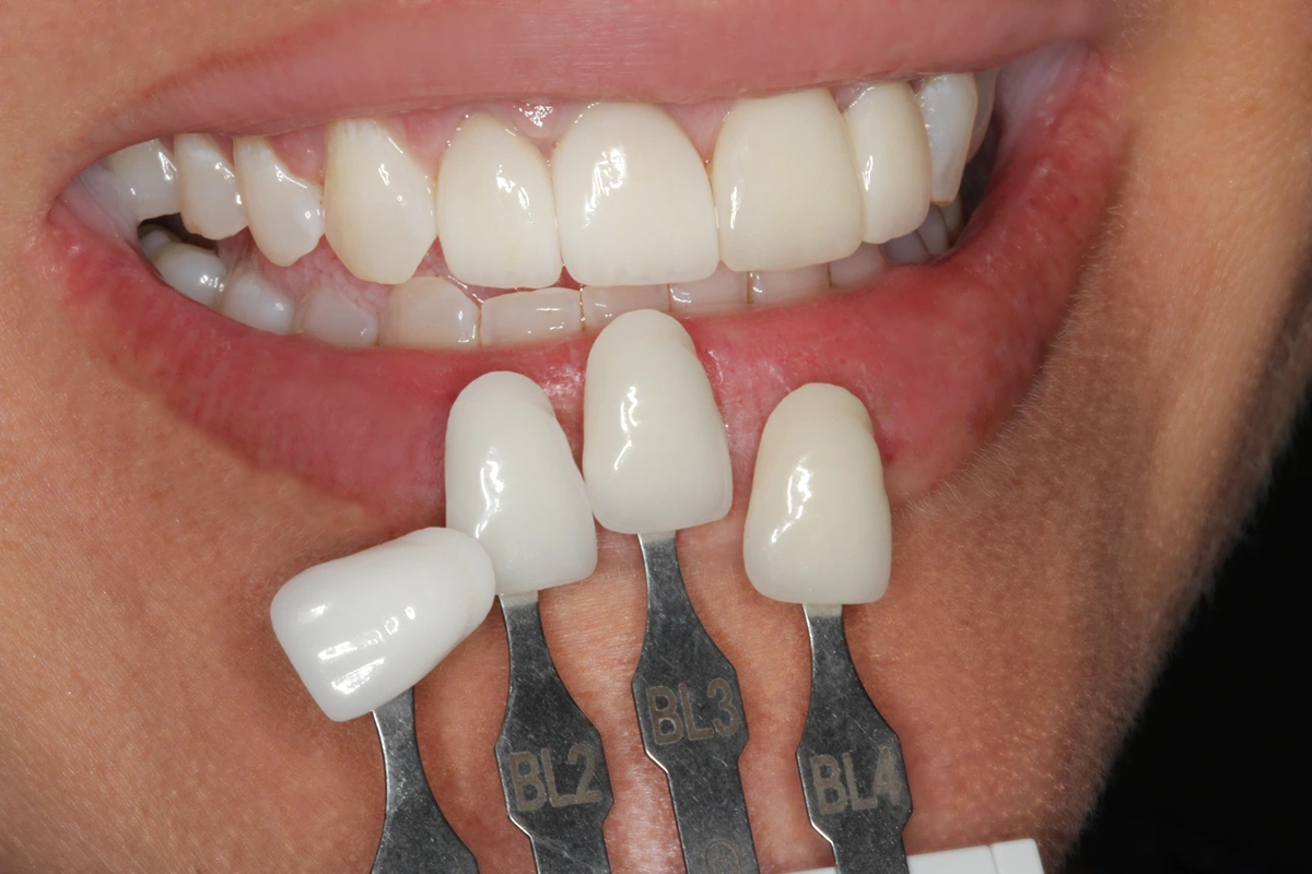 Custom Shading | Dani Dental Studio