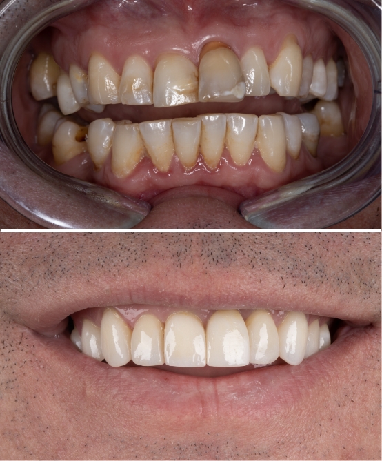 Dental Veneers | Cost of Veneers | Sydney Smile Doctor