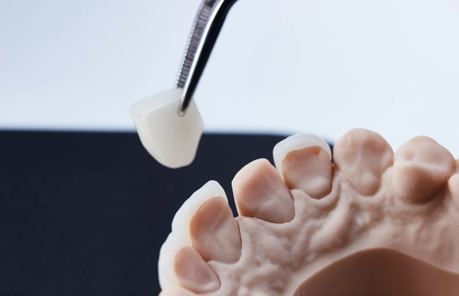 Veneers Price in the Philippines in 2024: All you need to know by Dr Jeff