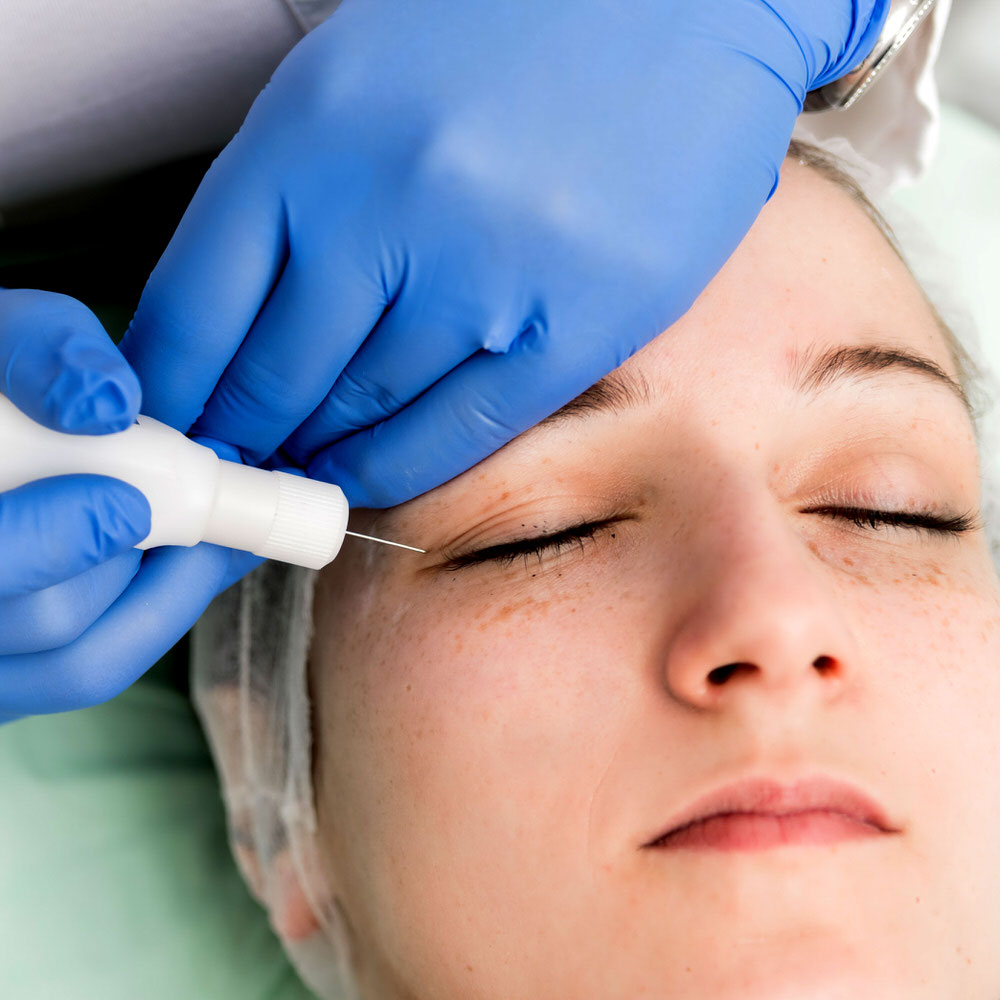 Plasma Fibroblast | Advanced Skin Treatments