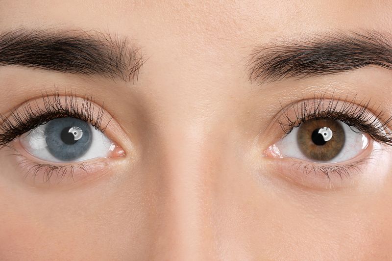 Do Your Eyes Look Different After Cataract Surgery? | West Boca Eye Center