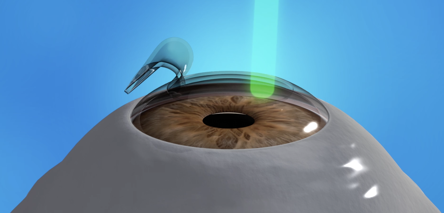New Laser Vision Correction Surgery | West Boca Eye Center