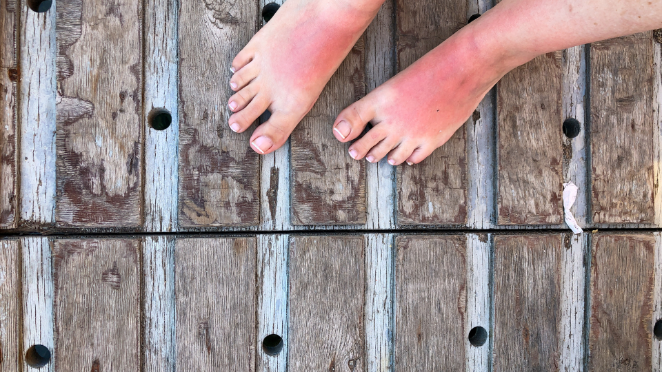 CPR and First Aid for Burn Victims: A Comprehensive Guide