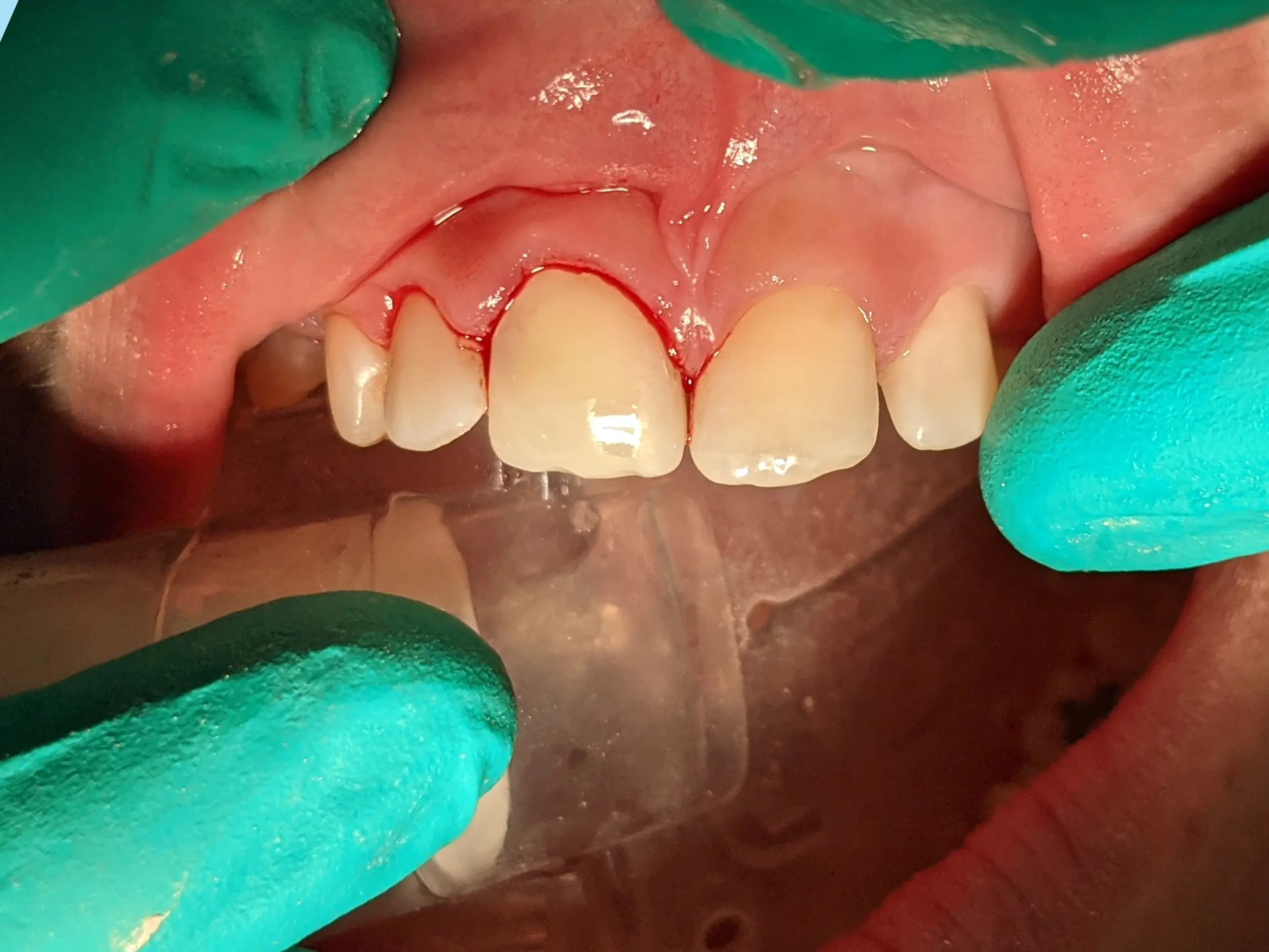 Before Afters | Campfire Smiles Pediatric Dentistry