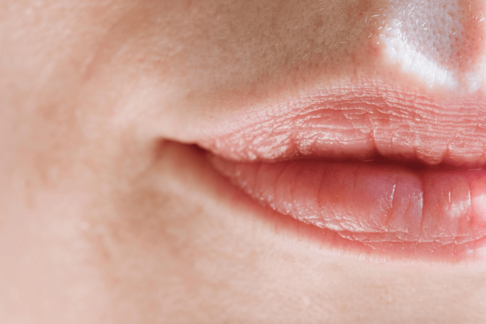 Eczema of the lips & mouth | Tend UK