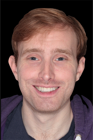 Composite bonding in London | Fix chipped teeth or broken teeth with ...