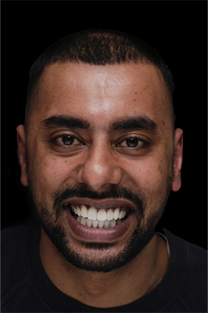 Composite bonding in London | Fix chipped teeth or broken teeth with ...