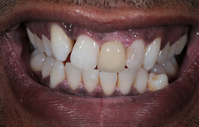 Composite bonding in London | Fix chipped teeth or broken teeth with ...