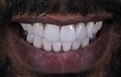 Composite bonding in London | Fix chipped teeth or broken teeth with ...