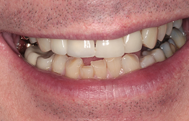 Composite bonding in London | Fix chipped teeth or broken teeth with ...