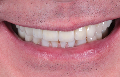 Composite bonding in London | Fix chipped teeth or broken teeth with ...