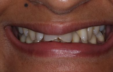 Composite bonding in London | Fix chipped teeth or broken teeth with ...