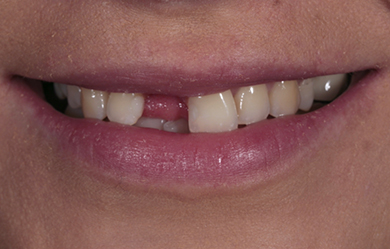 Composite bonding in London | Fix chipped teeth or broken teeth with ...