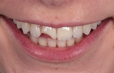 Composite bonding in London | Fix chipped teeth or broken teeth with ...