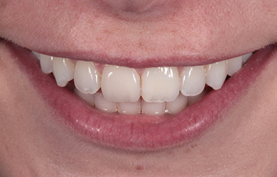 Composite bonding in London | Fix chipped teeth or broken teeth with ...