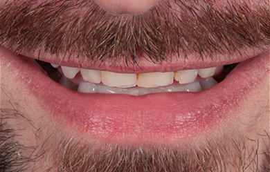 Composite bonding in London | Fix chipped teeth or broken teeth with ...