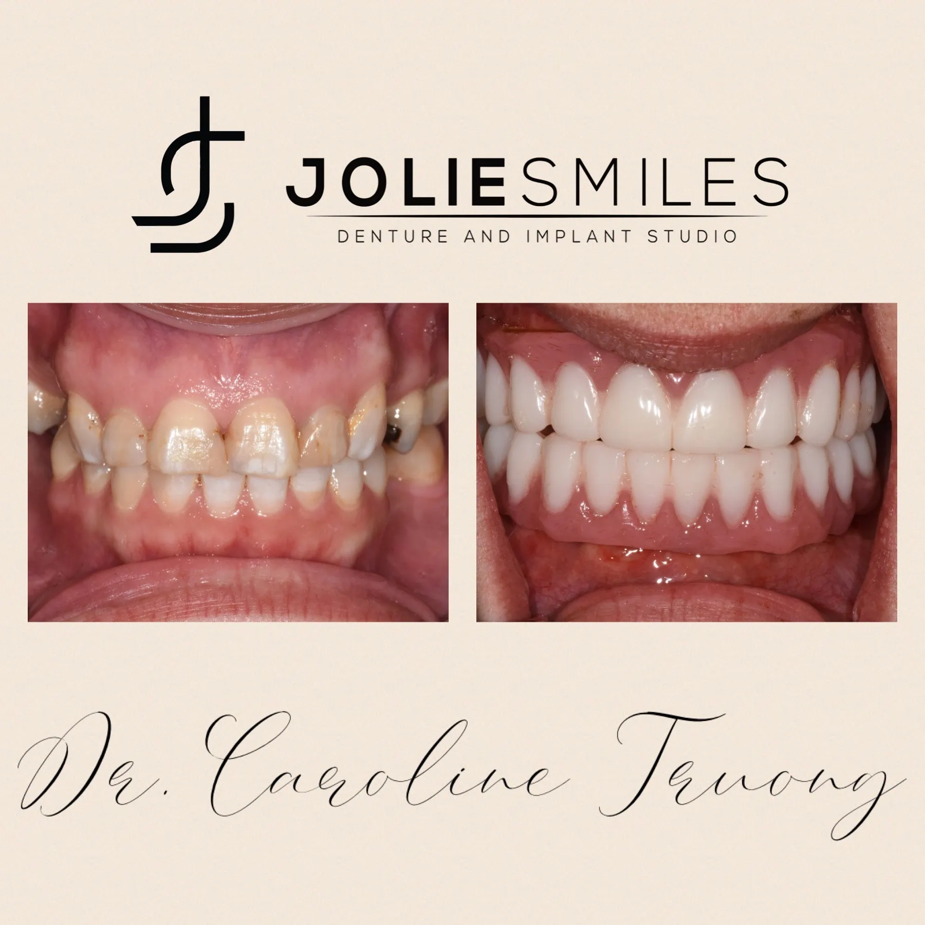 3D Printed Dentures in Odessa, FL | Same Day Dentures