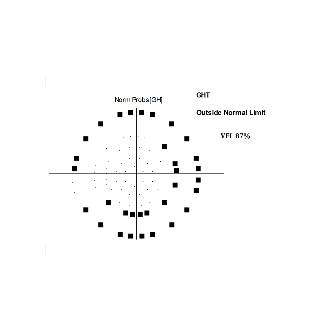 Appa Auto Perimeter AP901 CTS Glaufield Lite Swap