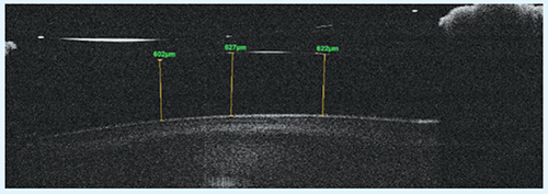 Refractive Implantable Lens (RIL) - Appasamy Hydrophilic Lens