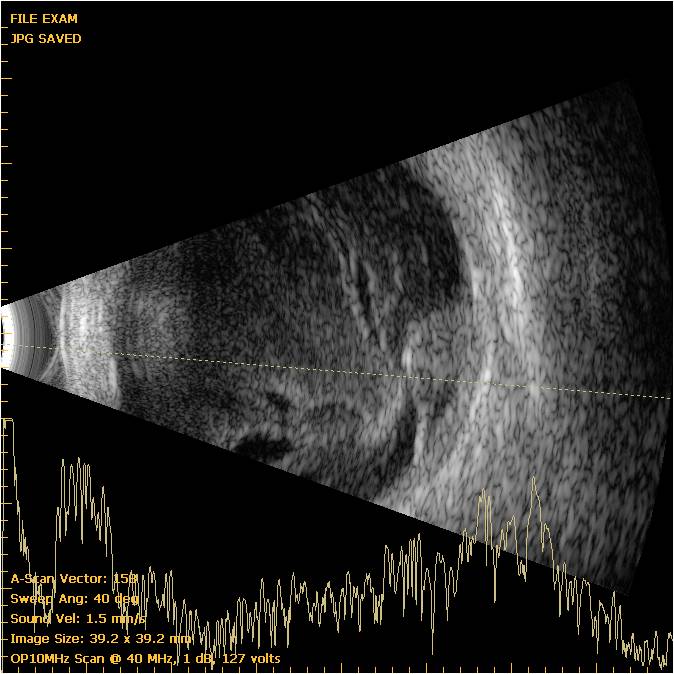 AB-SCAN with UBM: Ophthalmic Ultrasound Scanner - Appasamy