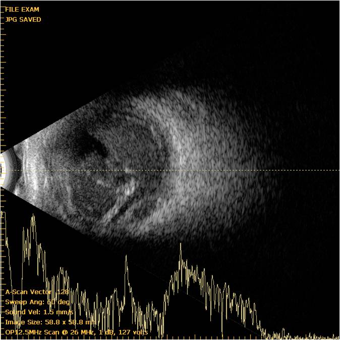 AB-SCAN with UBM: Ophthalmic Ultrasound Scanner - Appasamy