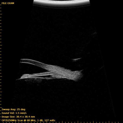 AB-SCAN with UBM: Ophthalmic Ultrasound Scanner - Appasamy