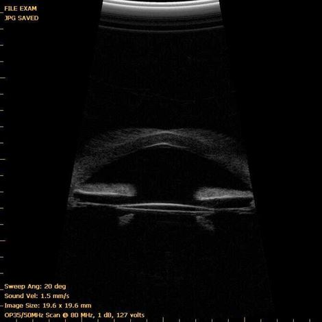 AB-SCAN with UBM: Ophthalmic Ultrasound Scanner - Appasamy