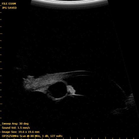 AB-SCAN with UBM: Ophthalmic Ultrasound Scanner - Appasamy
