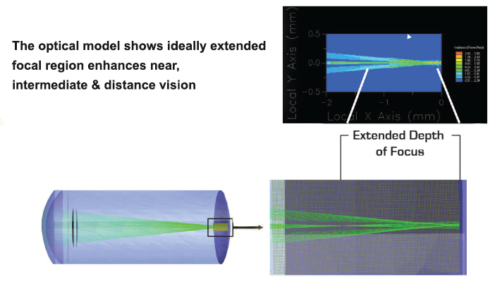 Supra Phob Infocus - Appasamy Hydrophobic Acrylic Lens/ Surgical IOL
