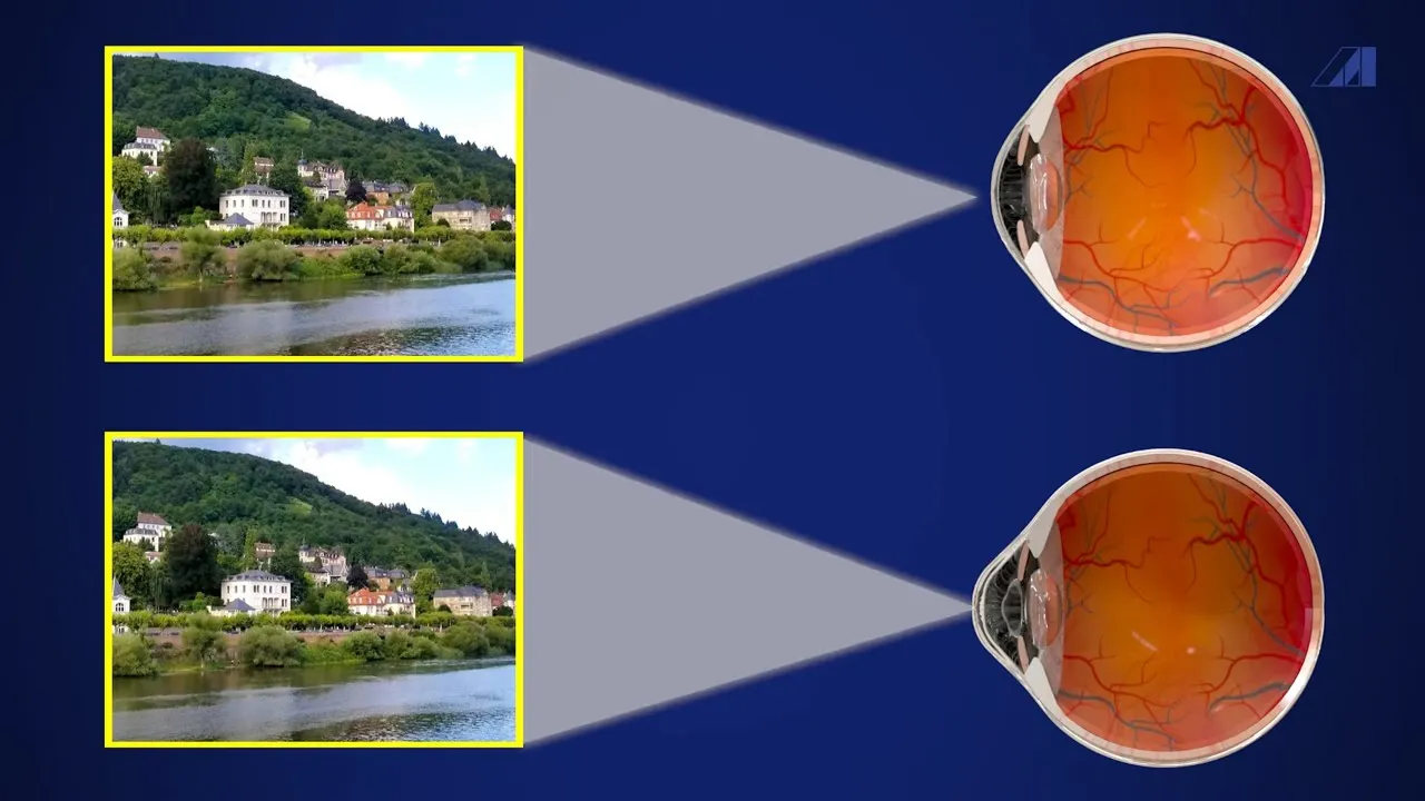 Supra Phob Toric - Appasamy Hydrophobic Acrylic Lens/ Surgical IOL