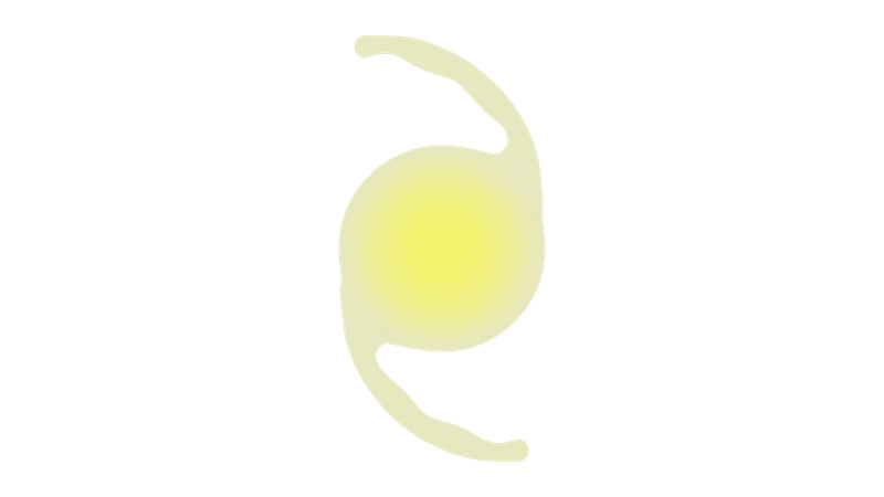 Supra Phob BBY - Appasamy Hydrophobic Acrylic Lens/ Surgical IOL