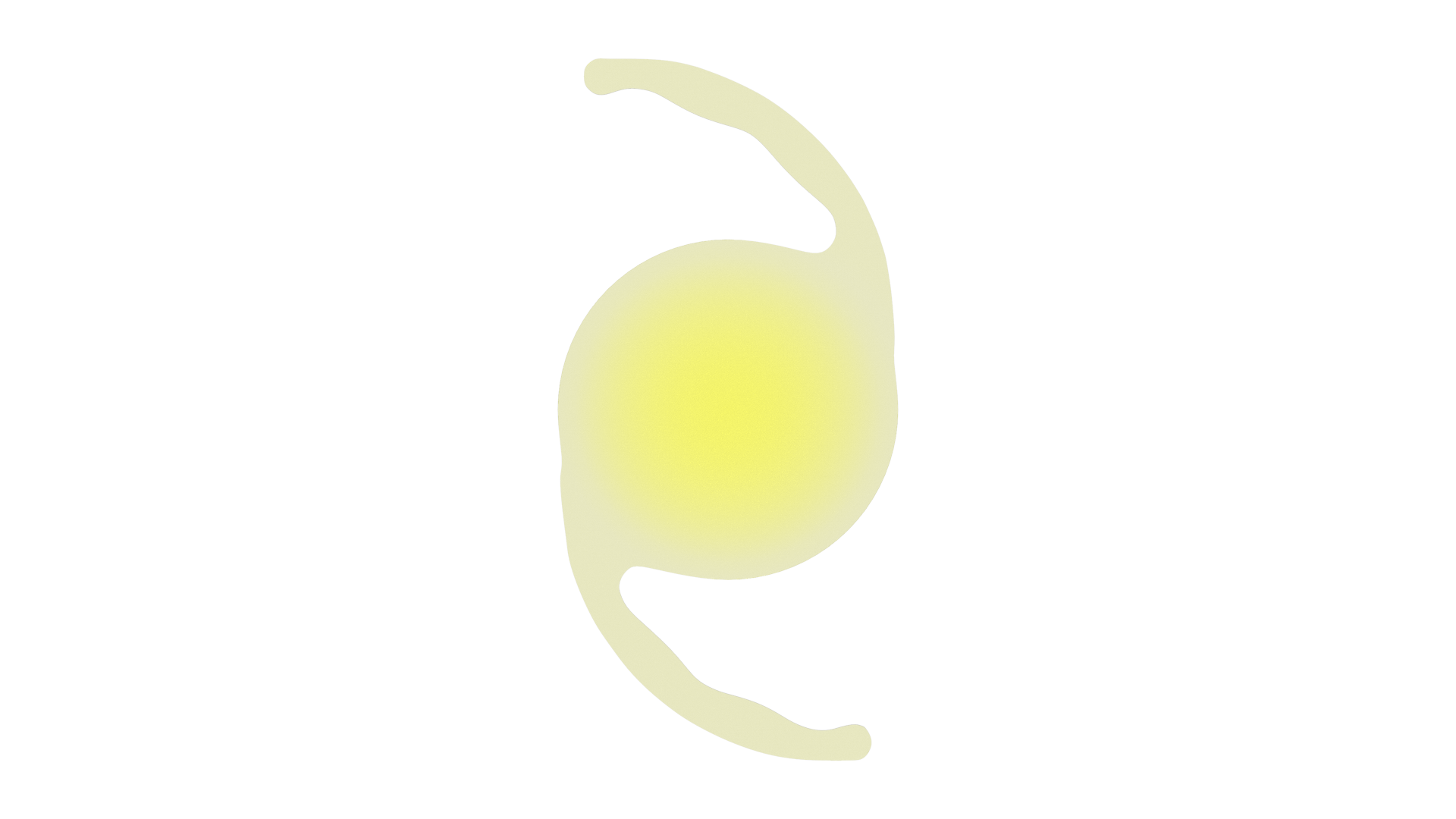 Supra Phob BBY - Appasamy Hydrophobic Acrylic Lens/ Surgical IOL