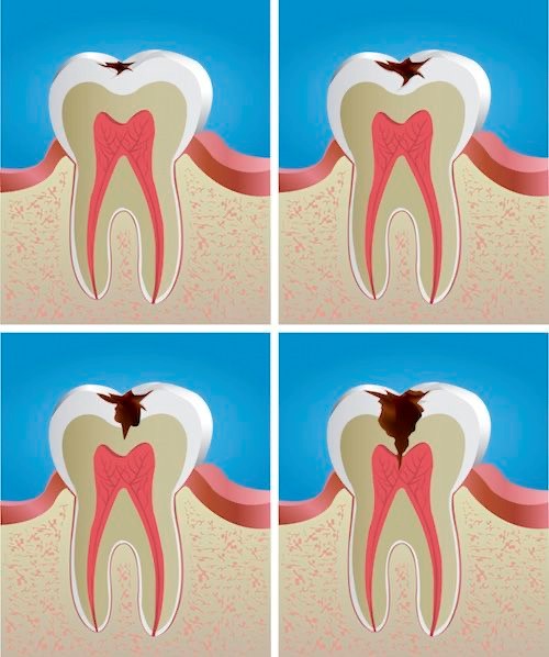 ¿Qué es un flemón? ¿Cómo se cura? - Branz Ortodoncia