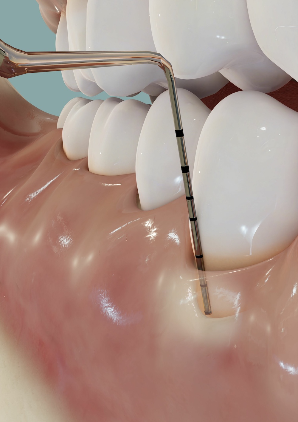 Periodontal Disease in Scottsdale, AZ | Scottsdale Perfect Smiles