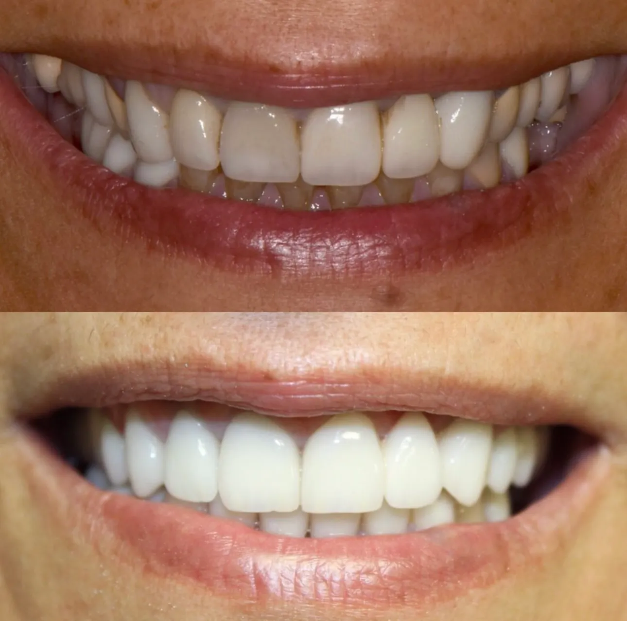 Before & Afters | Cedar Smiles Dentistry