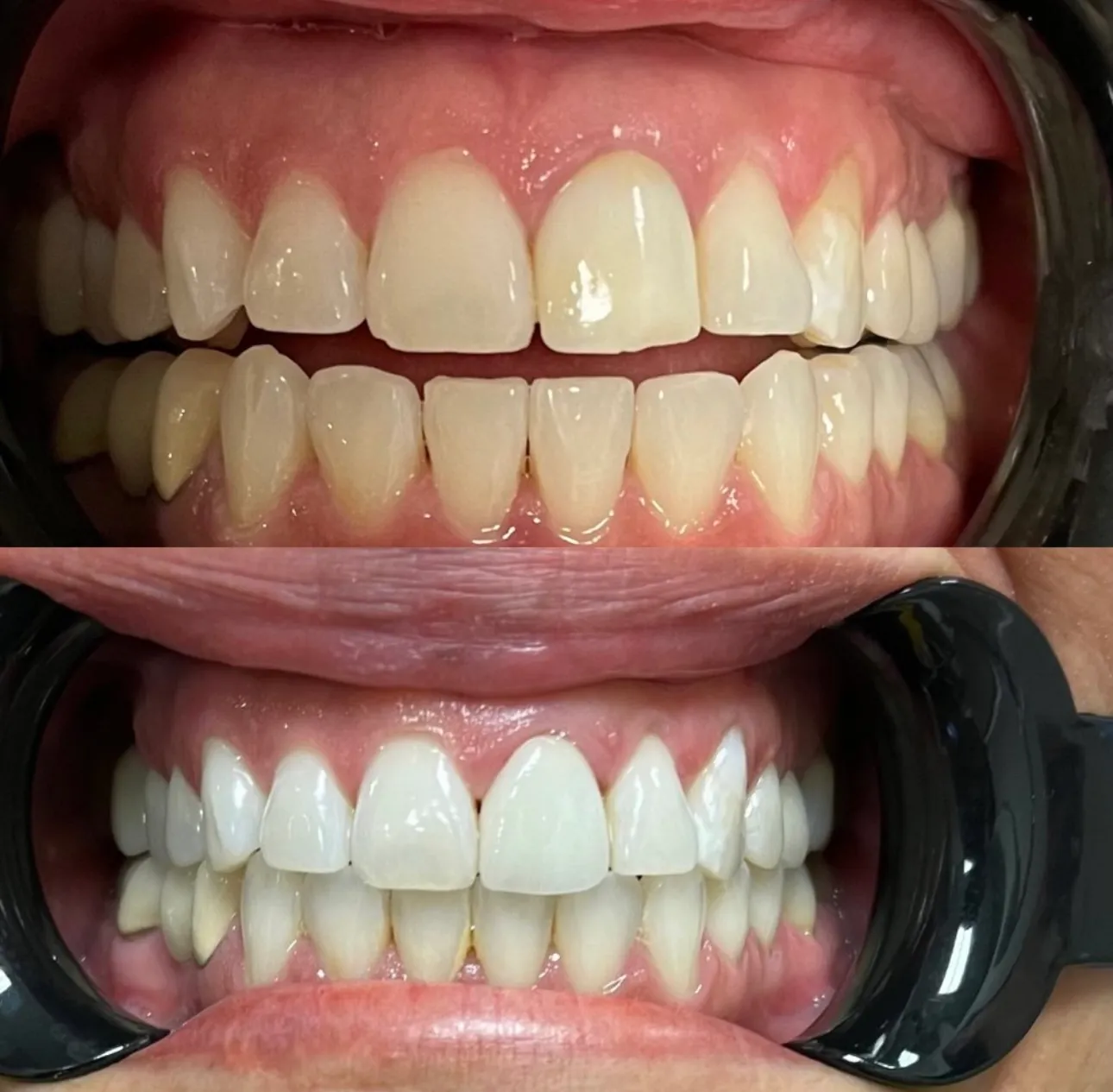 Before & Afters | Cedar Smiles Dentistry