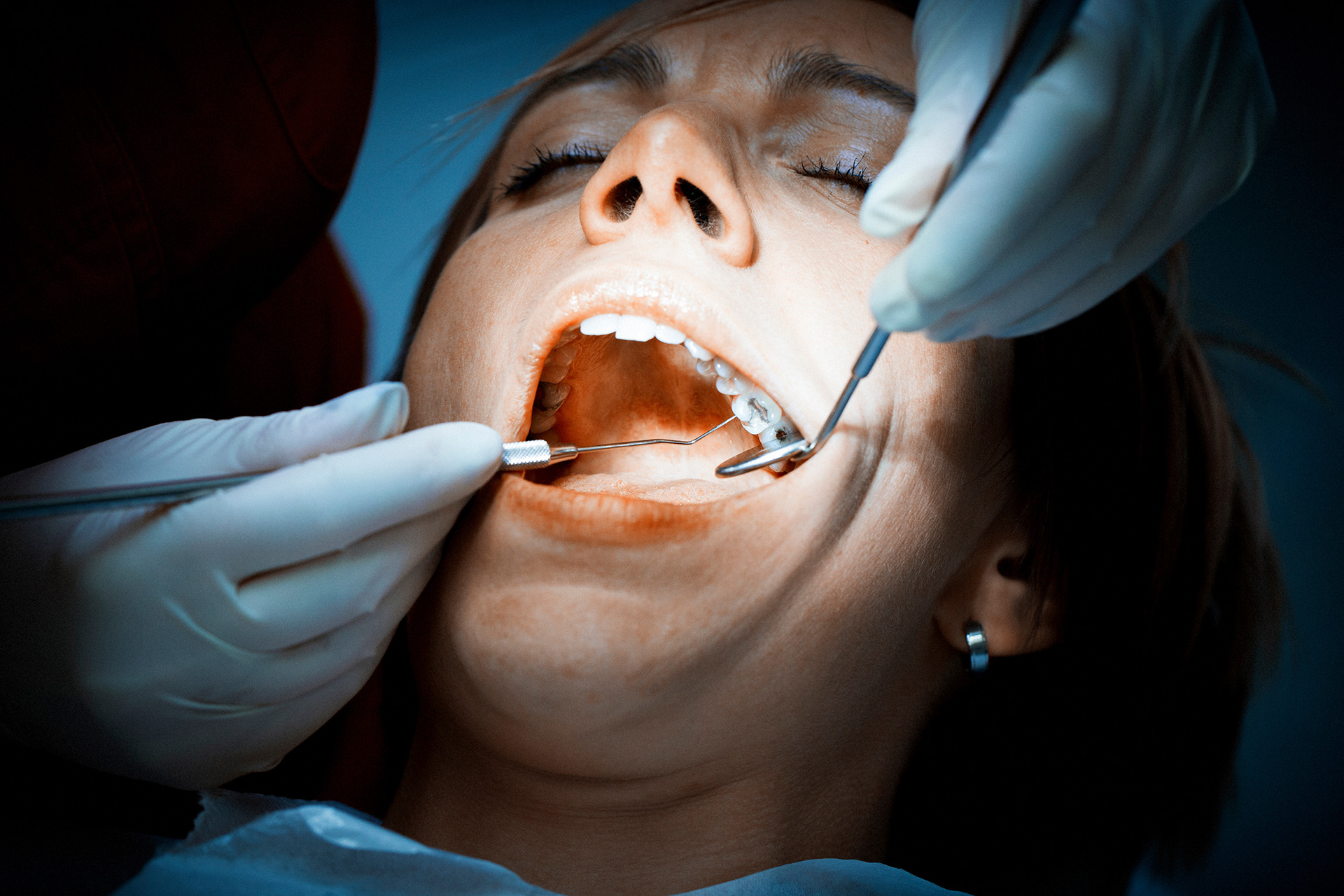SMART Amalgam Removal in Bellflower | Cedar Smiles Dentistry