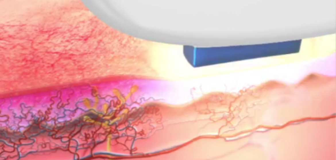 IRPL (Intense Regulated Pulsed Light) - STAR 9000 | Brescia