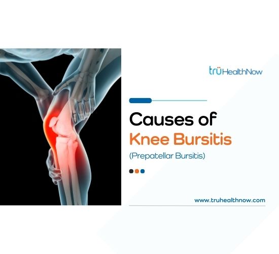 Causes of Knee Bursitis (Prepatellar Bursitis) | trüHealthNow