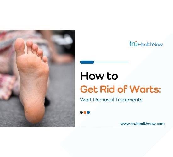 How to Get Rid of Warts: Wart Removal Treatments | trüHealthNow