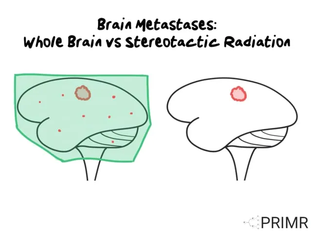 PRIMR | Brain Radiation versus Stereotactic Radiosurgery for Brain Metastases